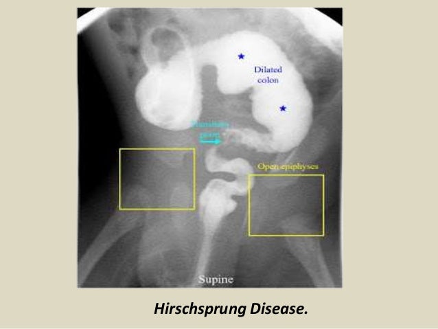 Presentation1, radiological imaging of hirshsprung disease.
