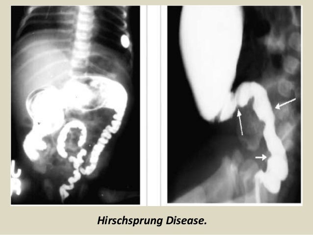 Presentation1, radiological imaging of hirshsprung disease.