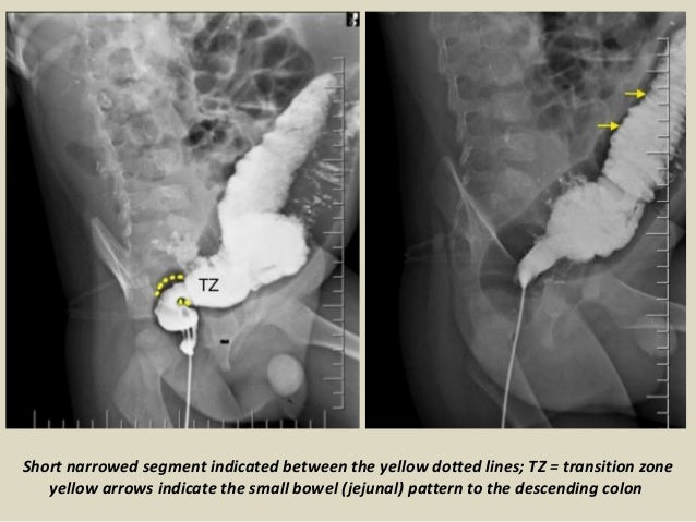 Presentation1, radiological imaging of hirshsprung disease.