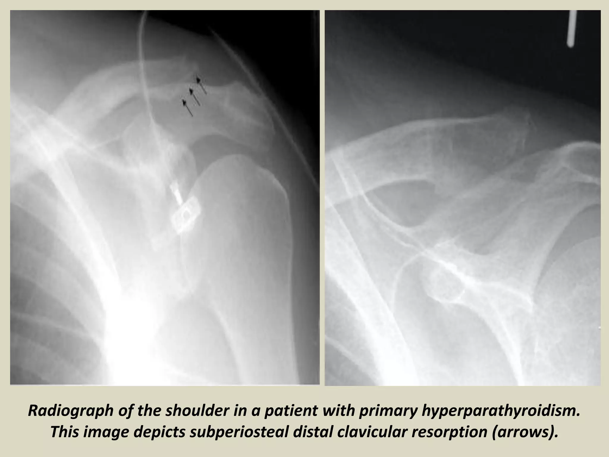 Presentation1, radiological imaging of hyperparathyroidism. | PPTX