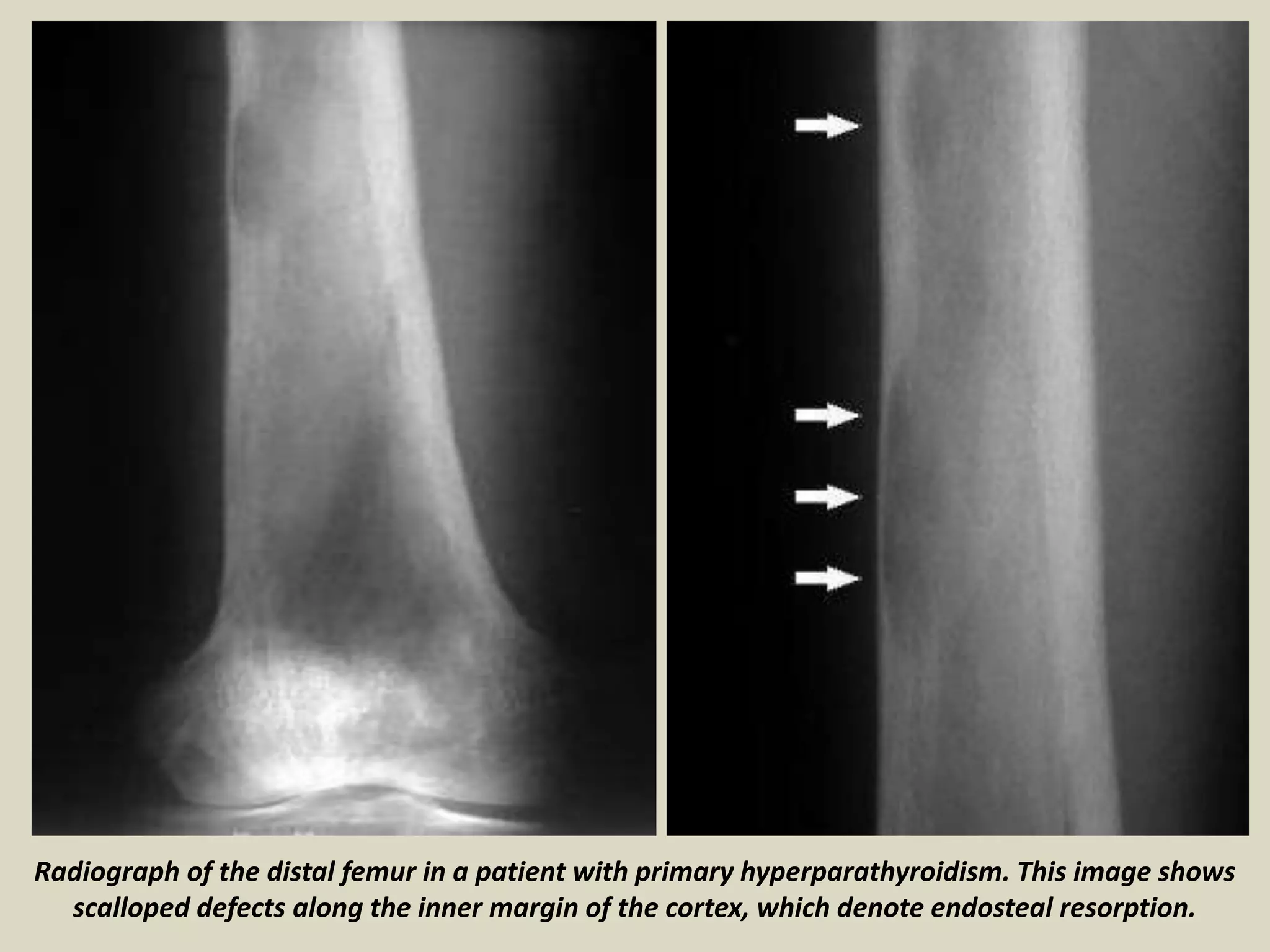 Presentation1, radiological imaging of hyperparathyroidism. | PPTX