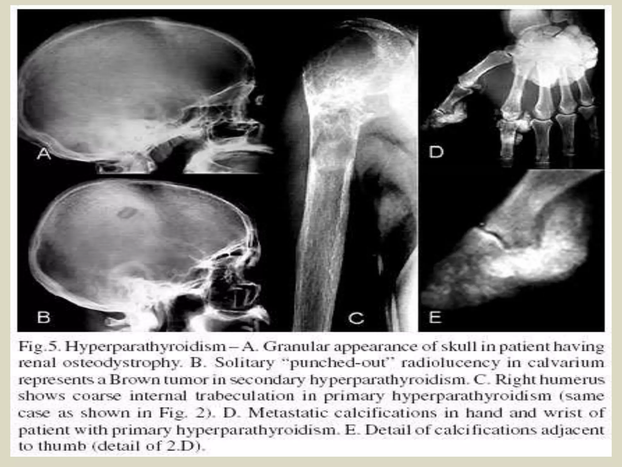 Presentation1, radiological imaging of hyperparathyroidism. | PPTX