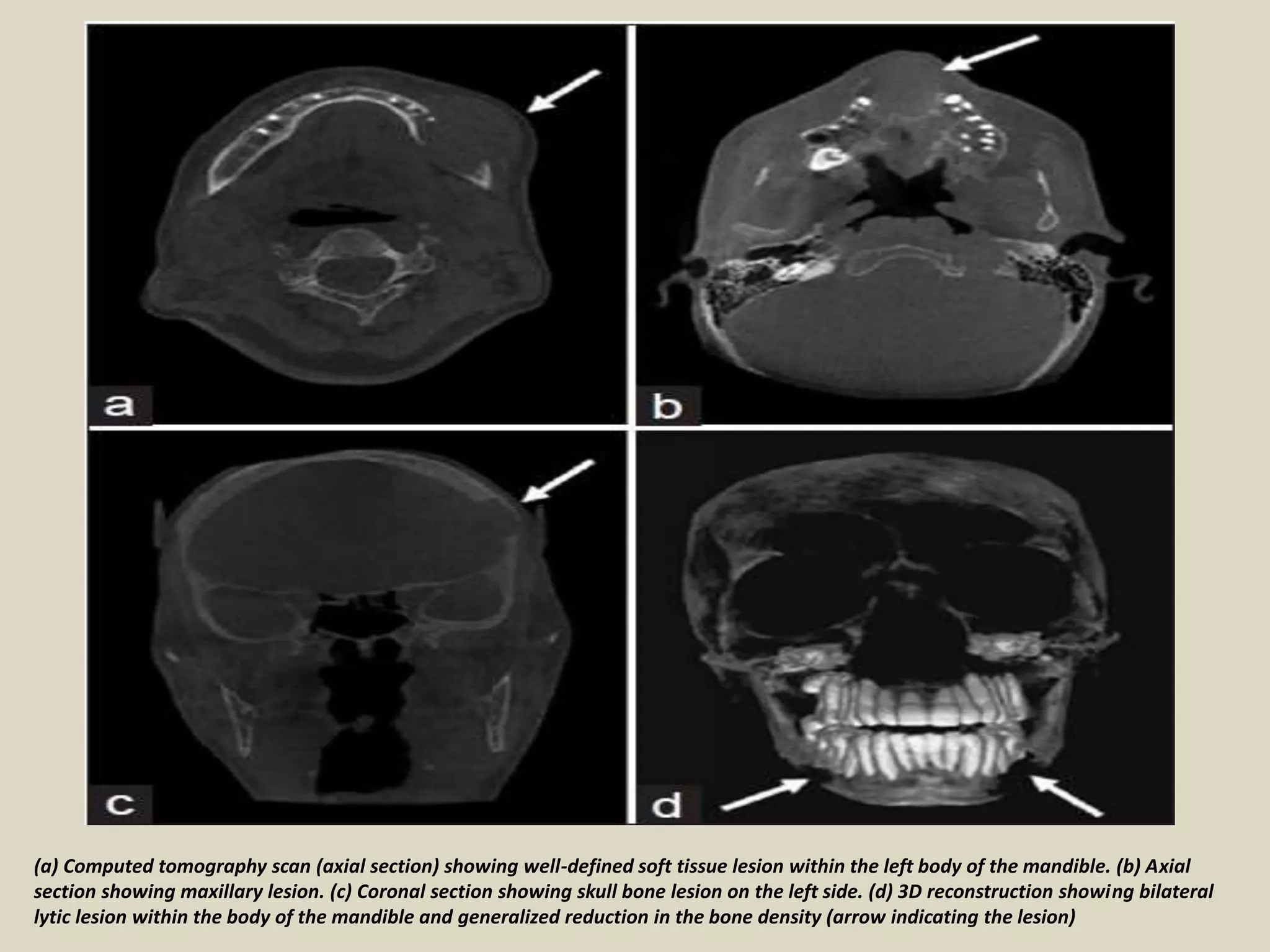 Presentation1, radiological imaging of hyperparathyroidism. | PPTX