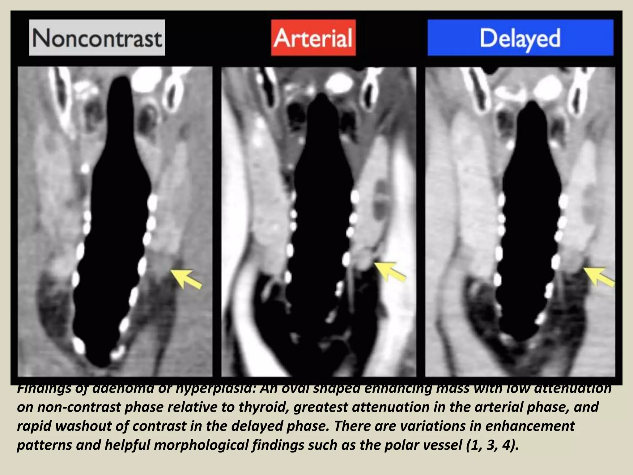 Presentation1, radiological imaging of hyperparathyroidism. | PPTX