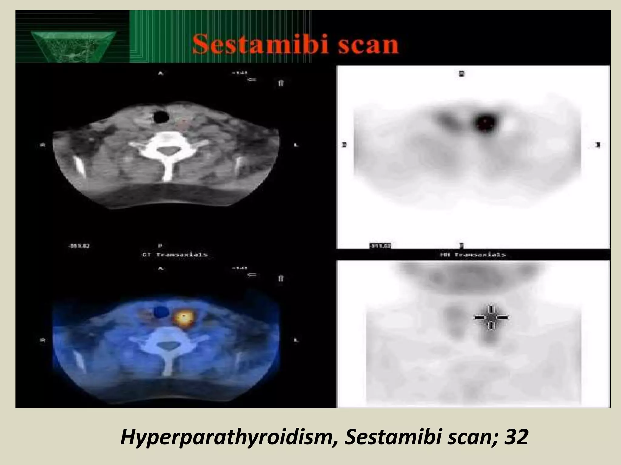Presentation1, radiological imaging of hyperparathyroidism. | PPTX
