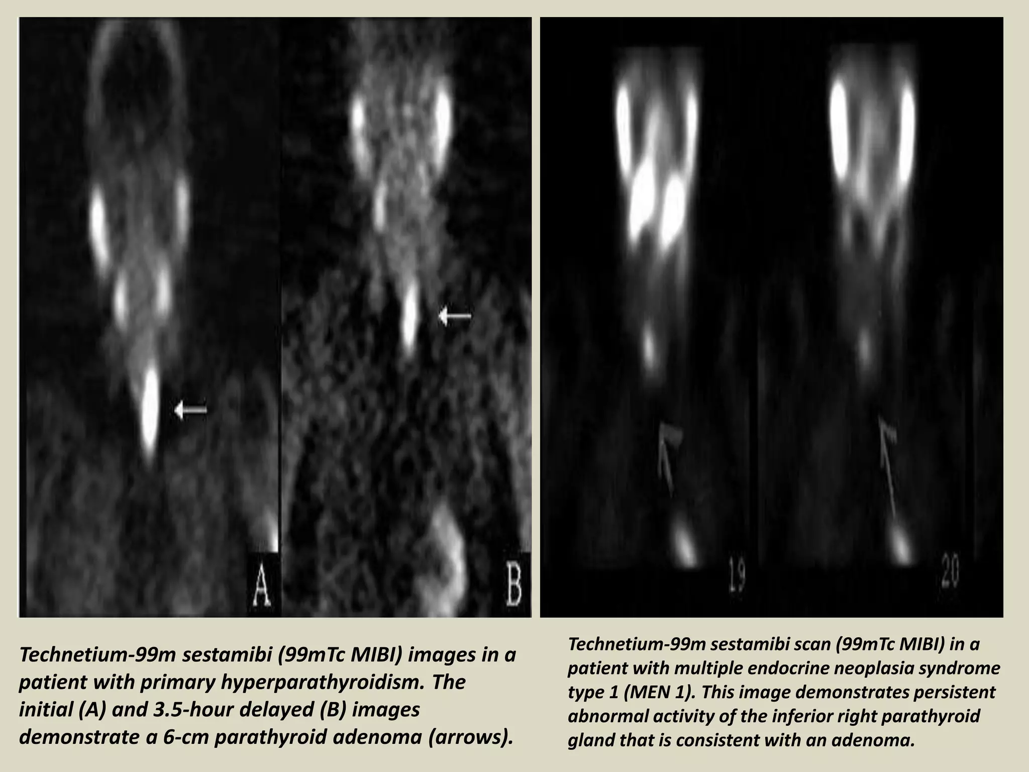 Presentation1, radiological imaging of hyperparathyroidism. | PPTX