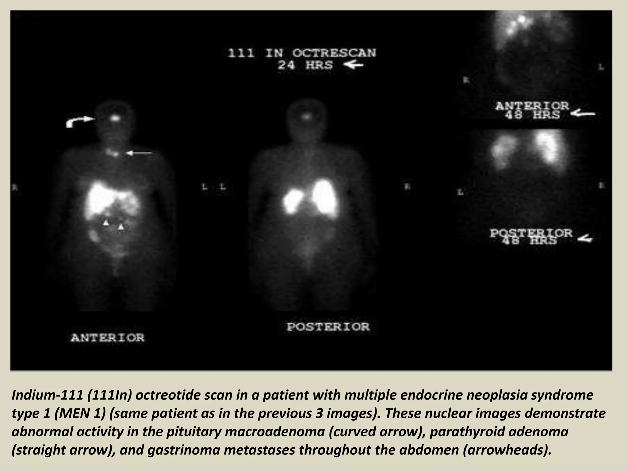Presentation1, radiological imaging of hyperparathyroidism. | PPTX