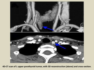 Presentation1, radiological imaging of hyperparathyroidism. | PPTX