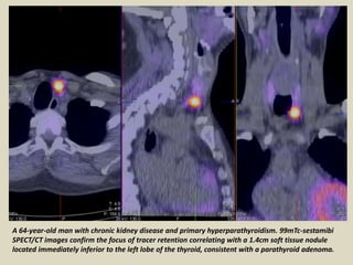 Presentation1, radiological imaging of hyperparathyroidism. | PPTX