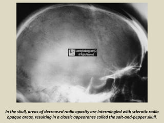 Primary Hyperparathyroidism Radiology