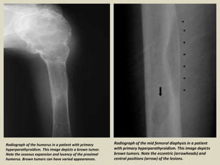 Hyperparathyroidism Patient