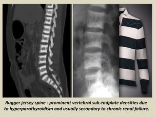 Primary Hyperparathyroidism Radiology