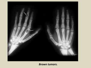 Primary Hyperparathyroidism Radiology