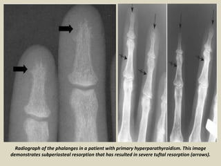 Hyperparathyroidism Patient