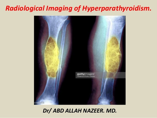 Presentation1, radiological imaging of hyperparathyroidism.