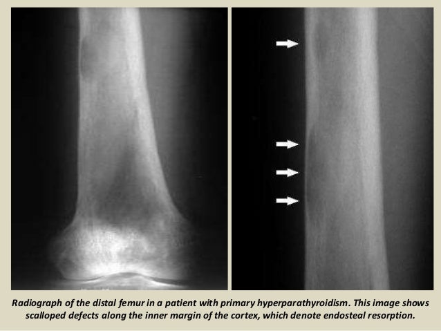 Primary Hyperparathyroidism Radiology
