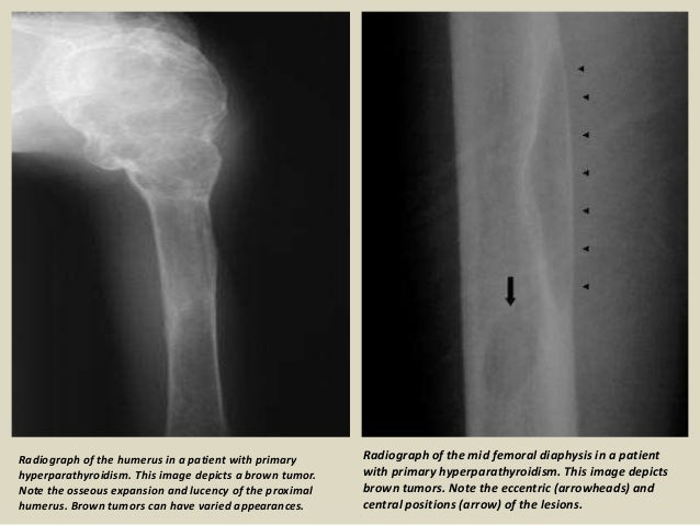 Primary Hyperparathyroidism Radiology