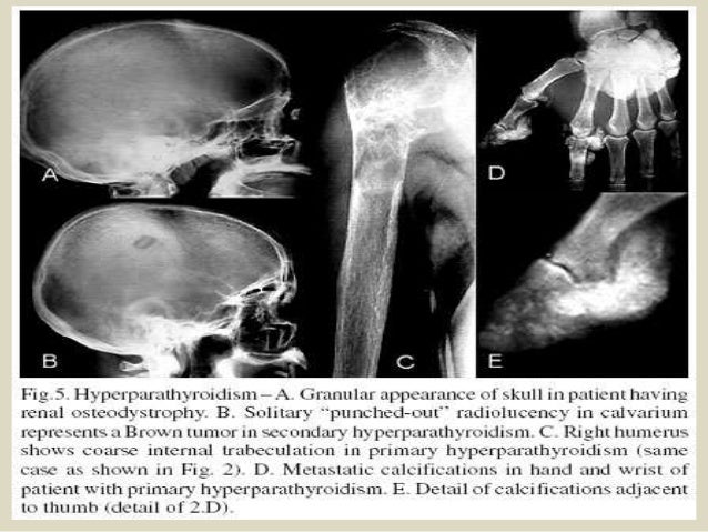Primary Hyperparathyroidism Radiology