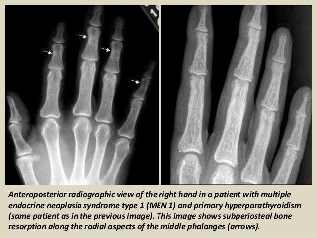 Primary Hyperparathyroidism Radiology
