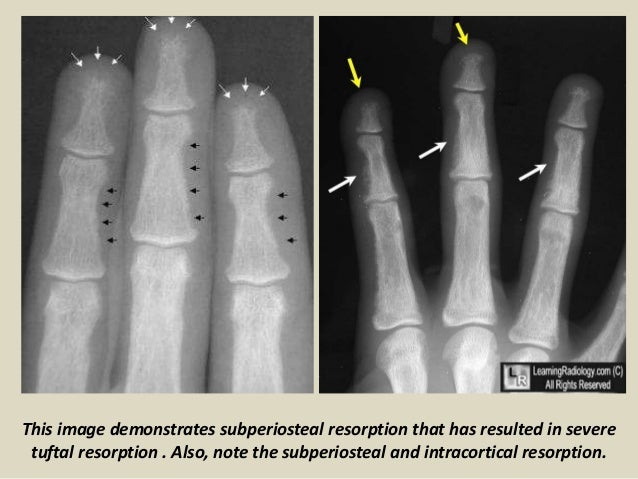 Presentation1, radiological imaging of hyperparathyroidism.