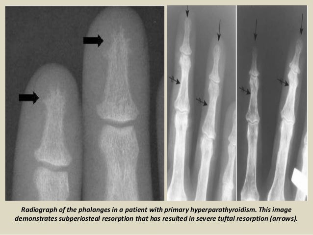 Primary Hyperparathyroidism Radiology