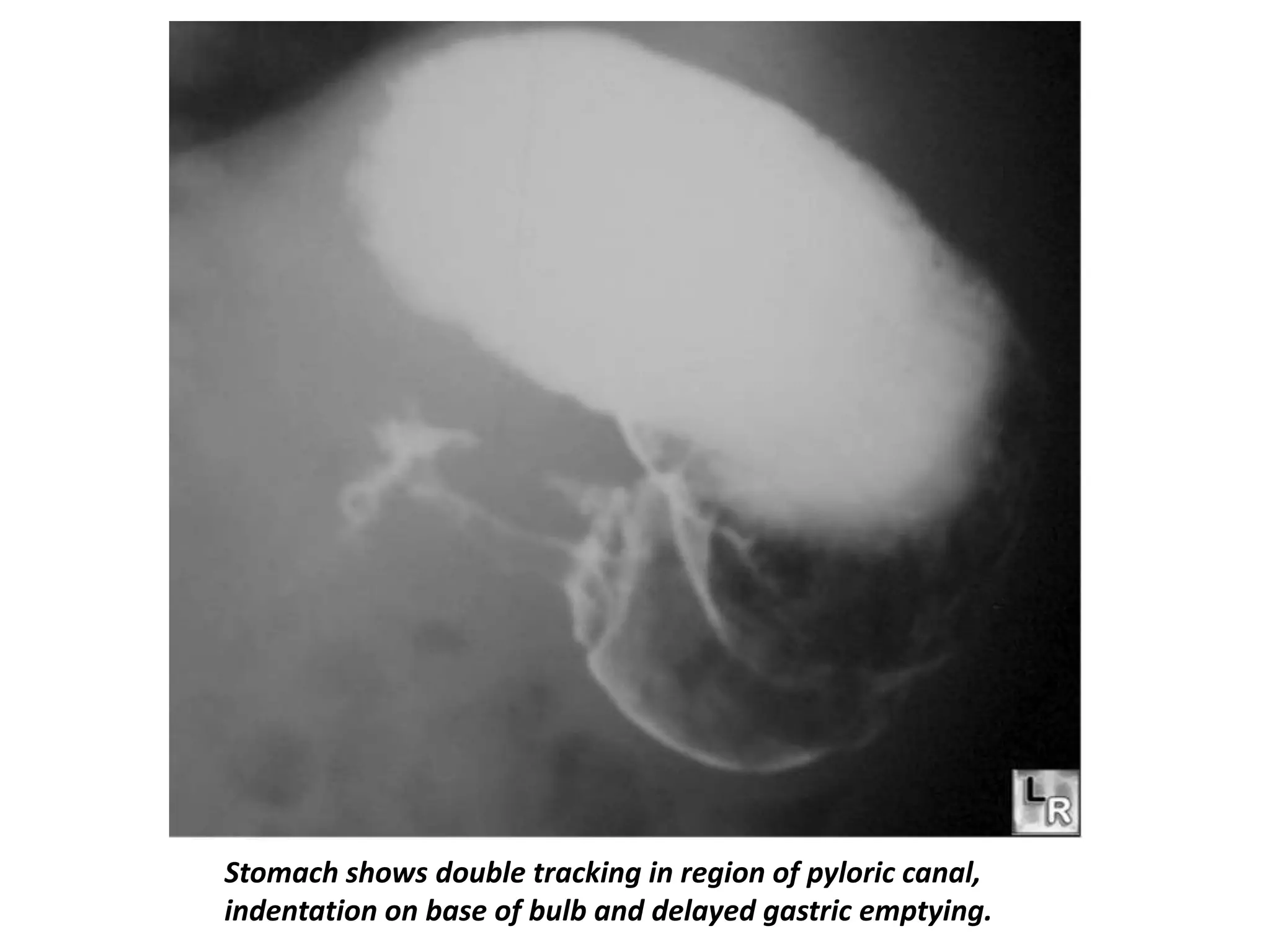 Presentation1, radiological imaging of hypertrophic pyloric stenosis ...