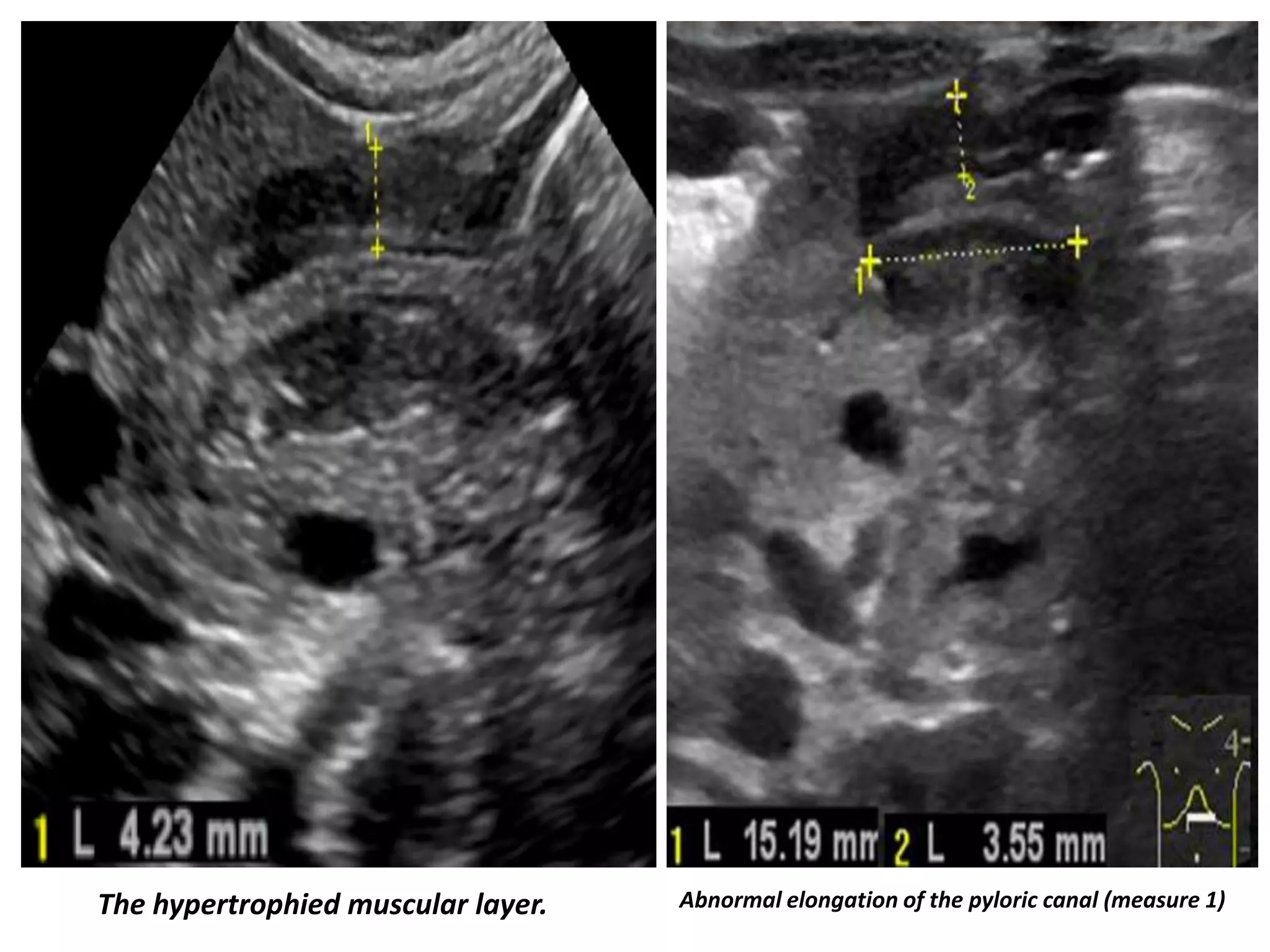 Presentation1, radiological imaging of hypertrophic pyloric stenosis ...