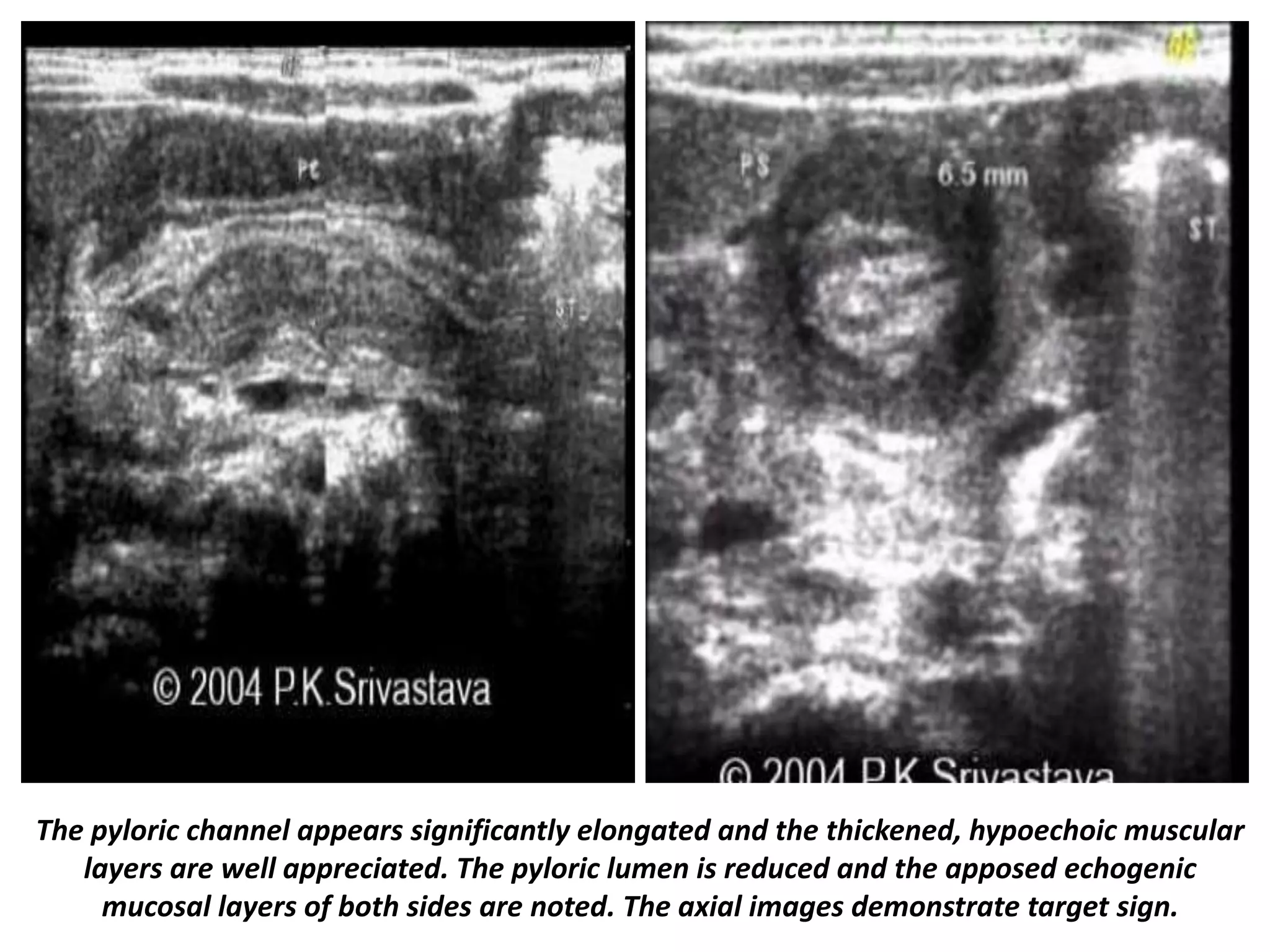 Presentation1, radiological imaging of hypertrophic pyloric stenosis ...