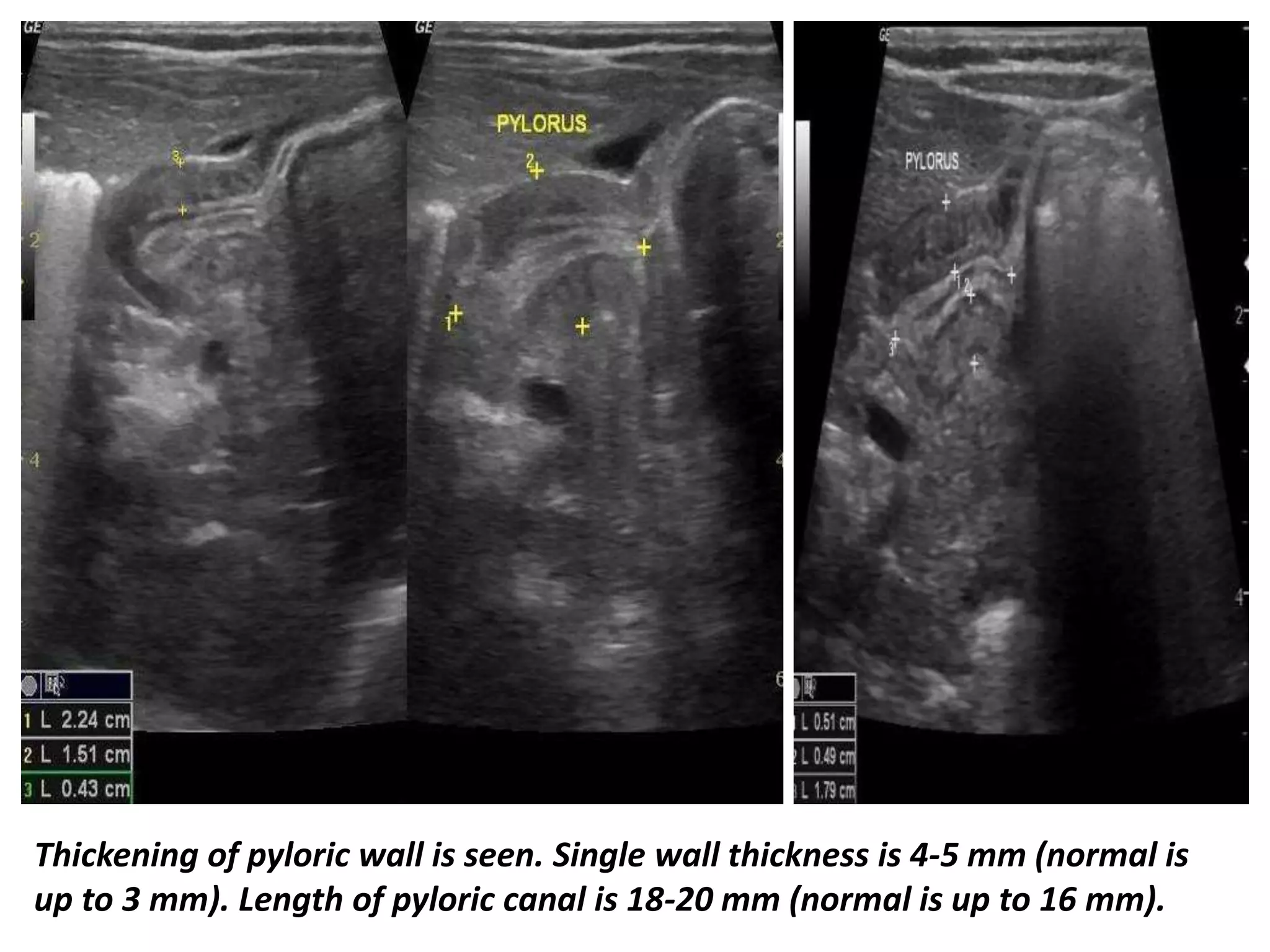 Presentation1, radiological imaging of hypertrophic pyloric stenosis ...