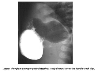 Presentation1, radiological imaging of hypertrophic pyloric stenosis ...