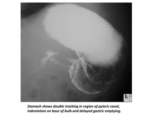 Presentation1, radiological imaging of hypertrophic pyloric stenosis ...