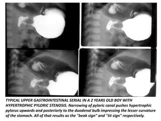 Presentation1, radiological imaging of hypertrophic pyloric stenosis ...