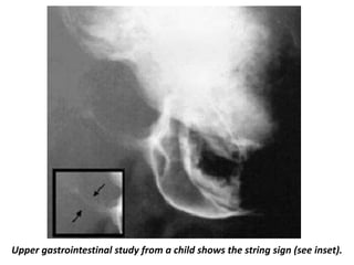 Pyloric Stenosis String Sign