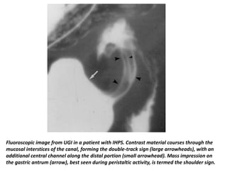 Double Track Sign Pyloric Stenosis