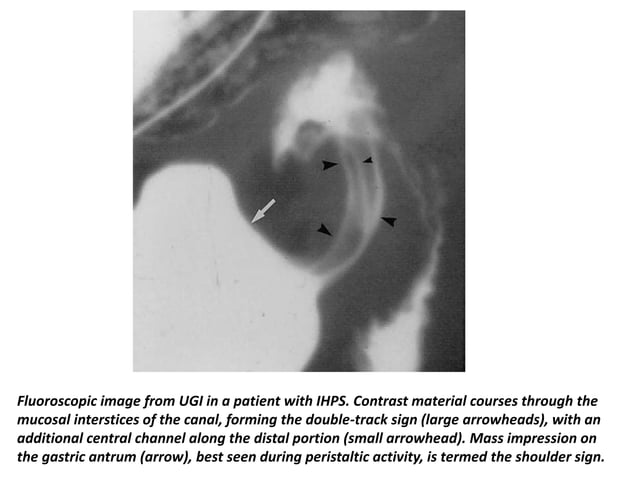 Hypertrophic Pyloric Stenosis