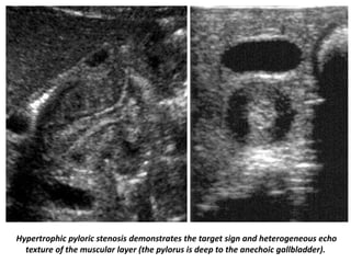 Pyloric Stenosis Ultrasound Protocol