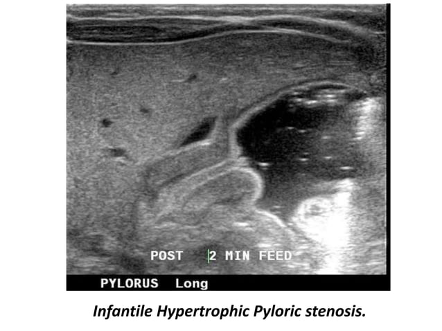 Presentation1, radiological imaging of hypertrophic pyloric stenosis.