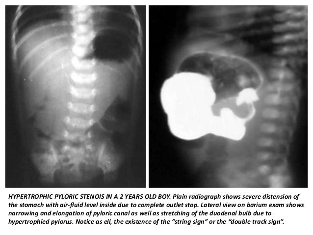 Presentation1, radiological imaging of hypertrophic pyloric stenosis.