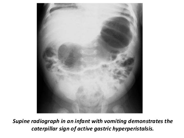 Presentation1, radiological imaging of hypertrophic pyloric stenosis.