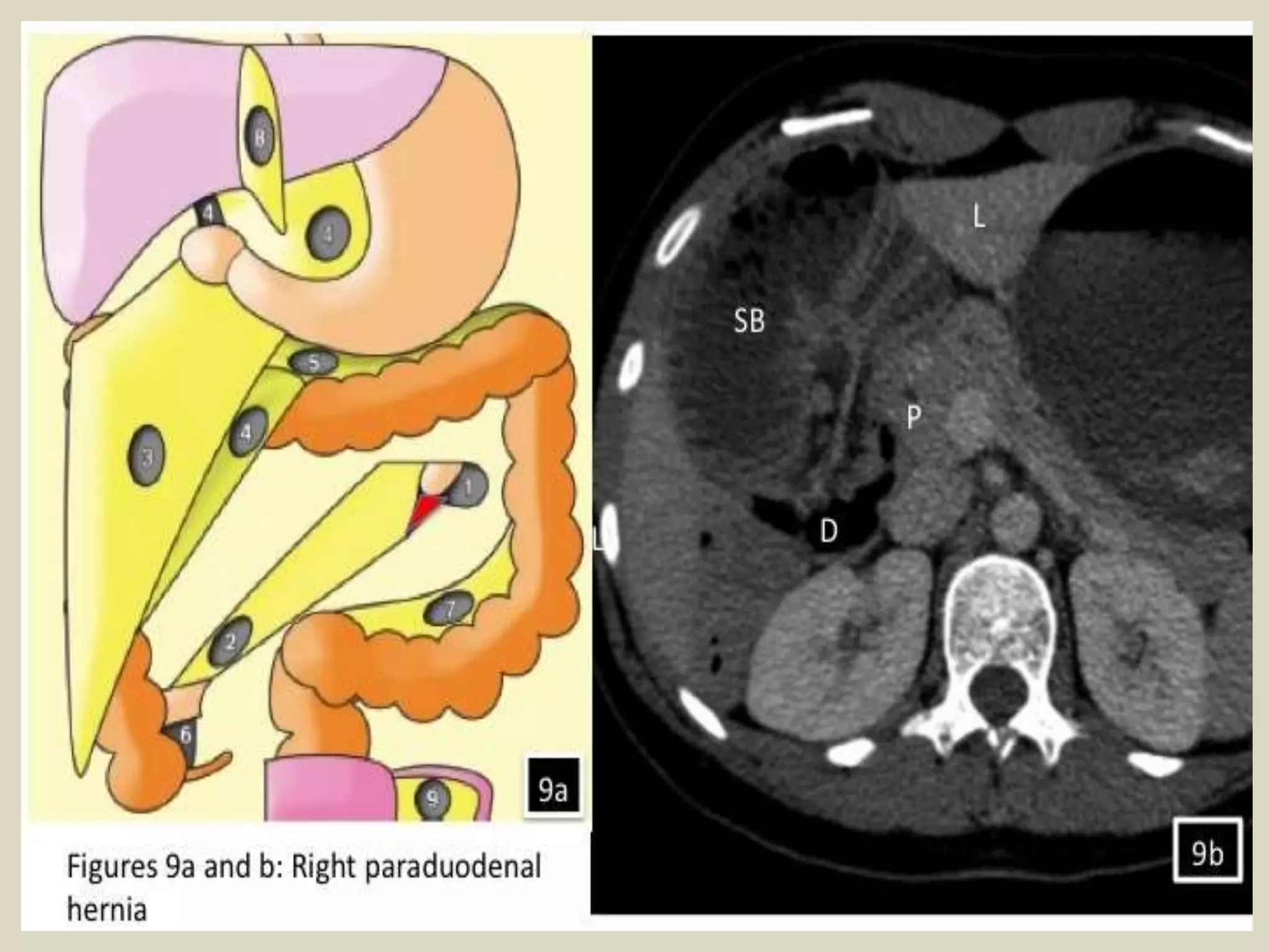 Presentation1, radiological imaging of internal abdominal hernia. | PPTX