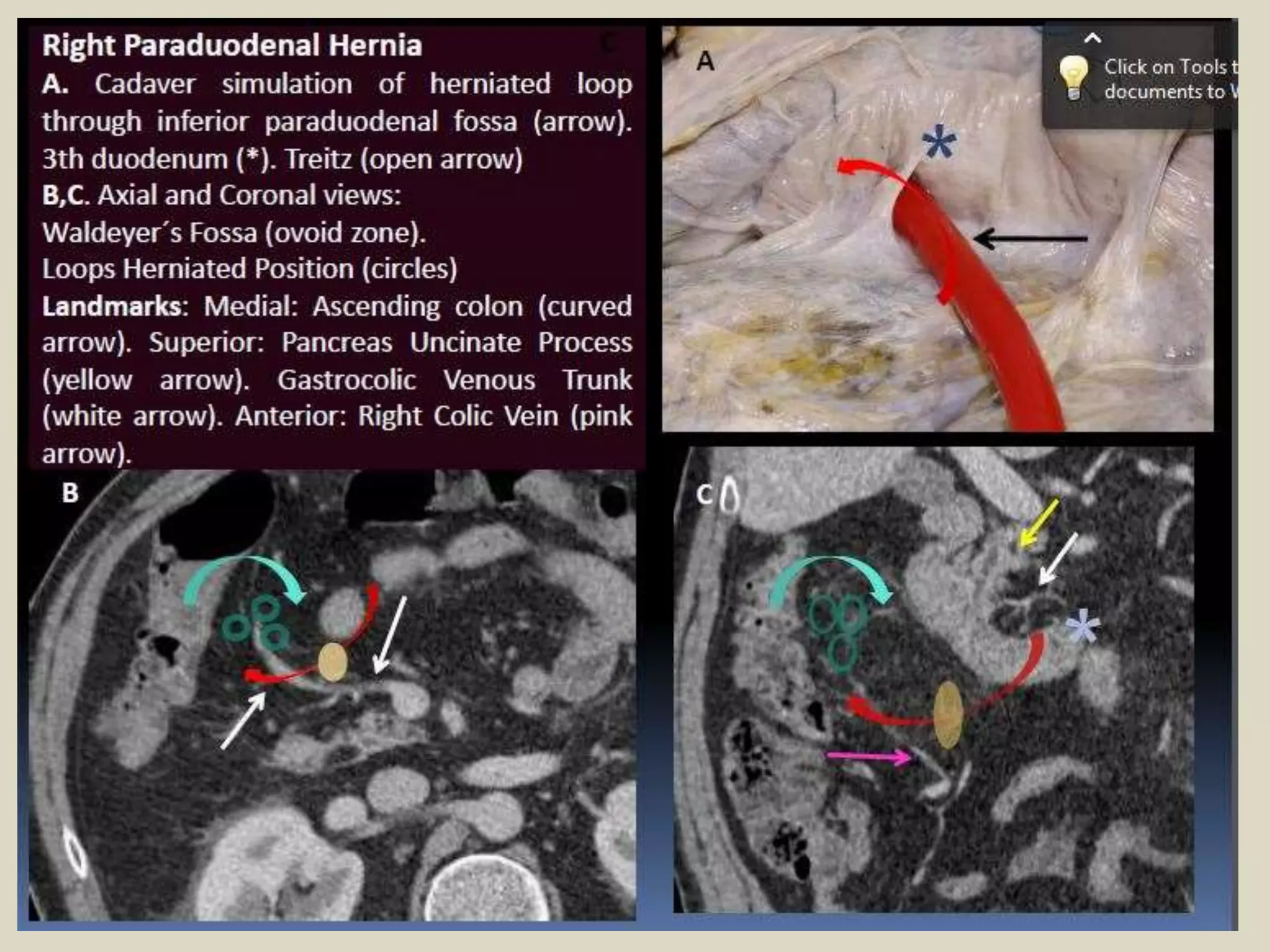 Presentation1, radiological imaging of internal abdominal hernia. | PPTX