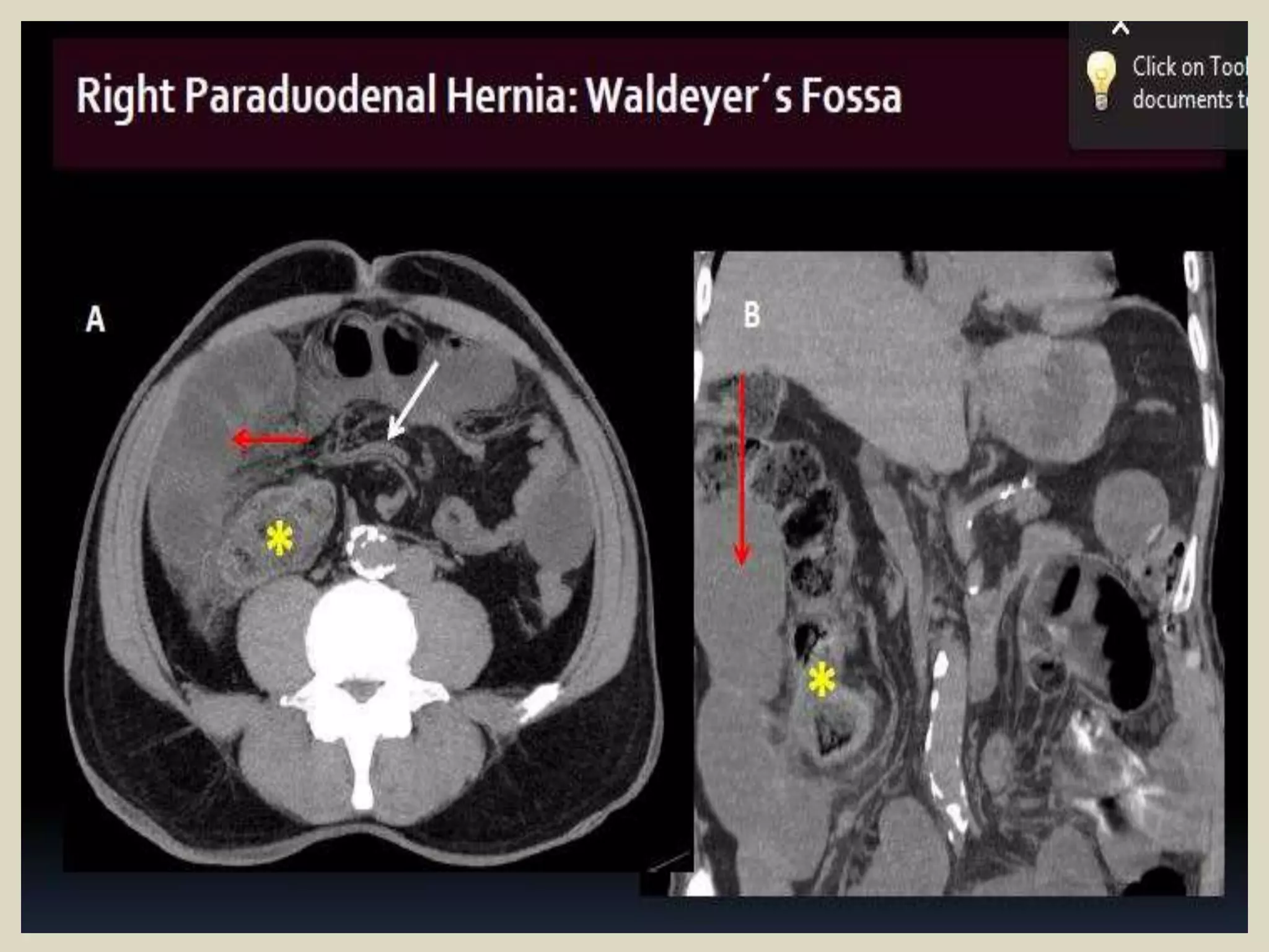 Presentation1, radiological imaging of internal abdominal hernia. | PPTX
