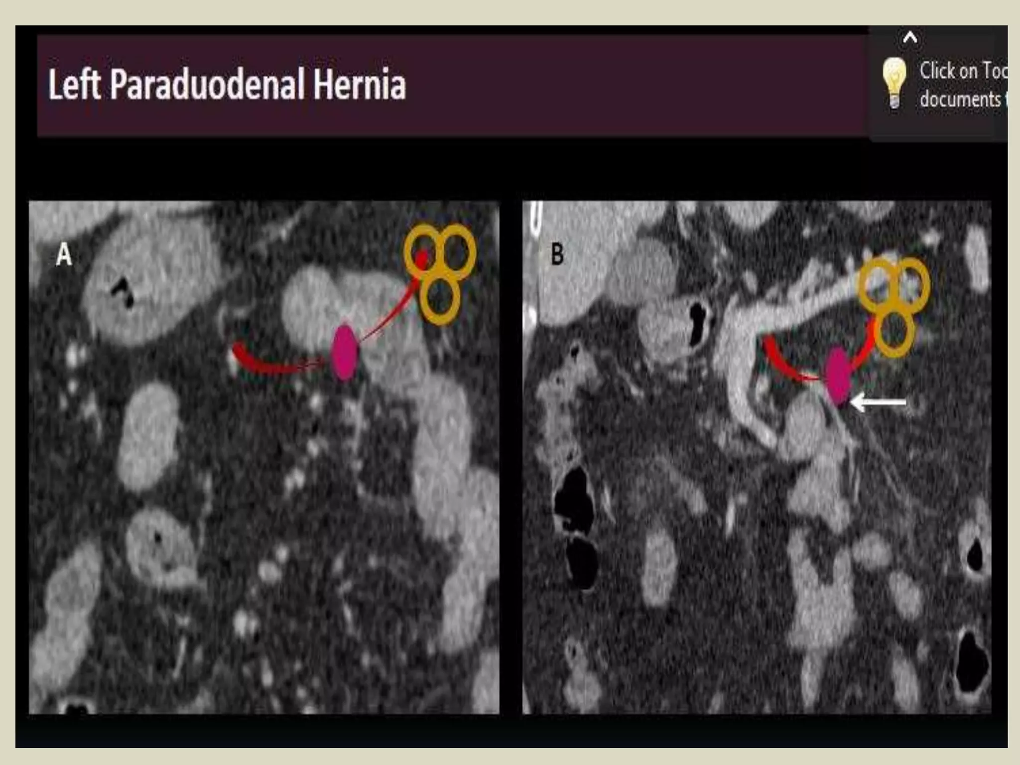 Presentation1, radiological imaging of internal abdominal hernia. | PPTX