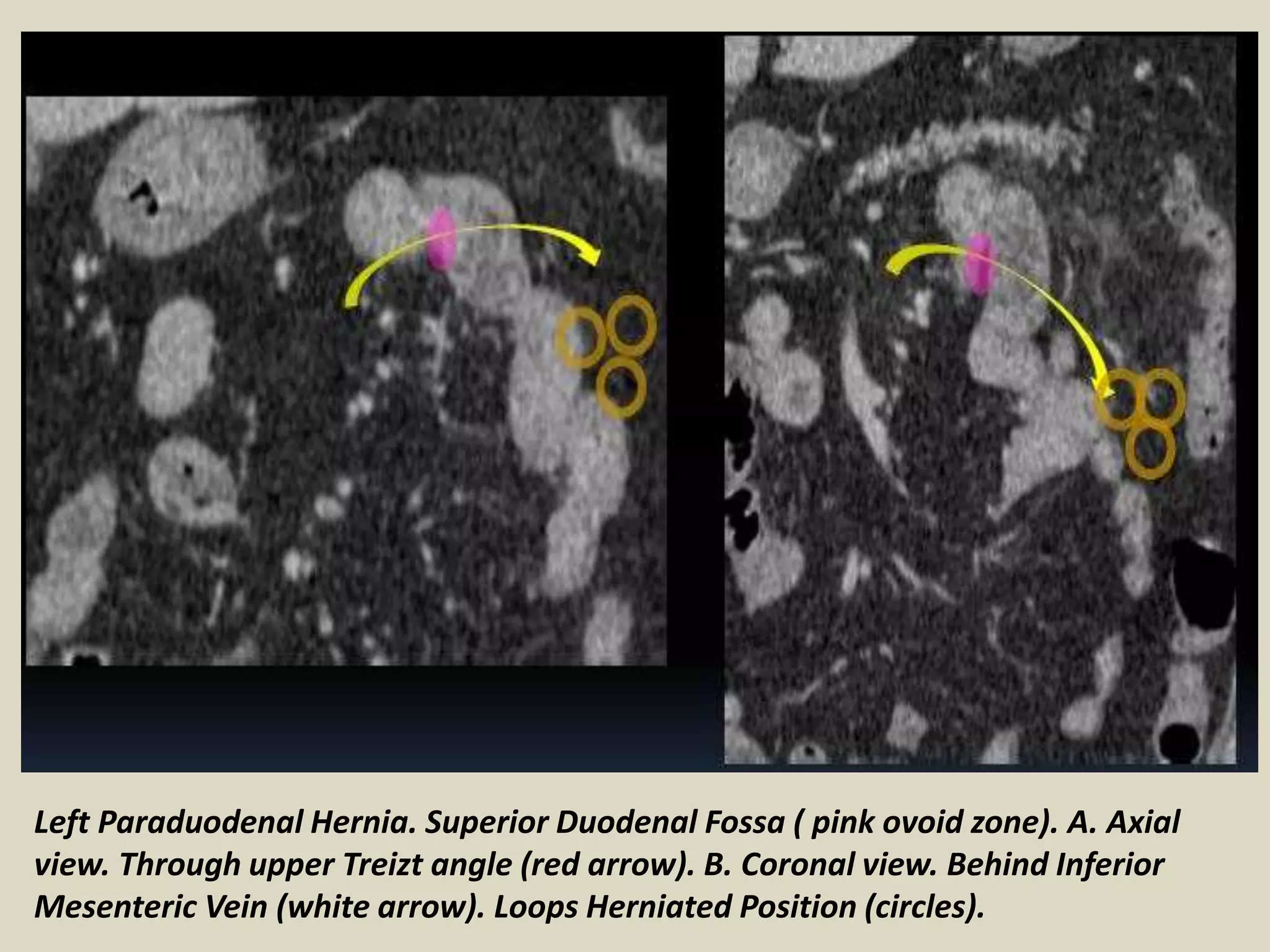 Presentation1, radiological imaging of internal abdominal hernia. | PPTX