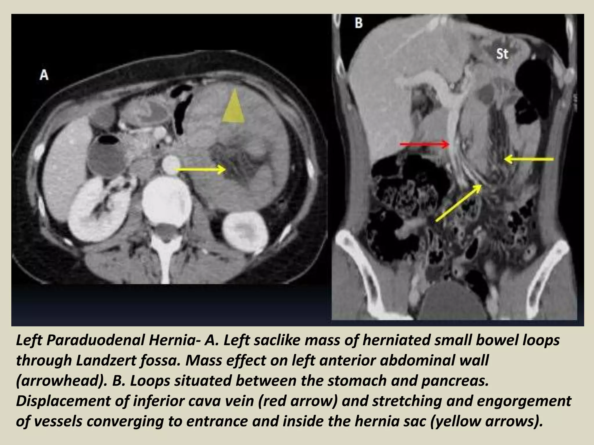 Presentation1, radiological imaging of internal abdominal hernia. | PPTX