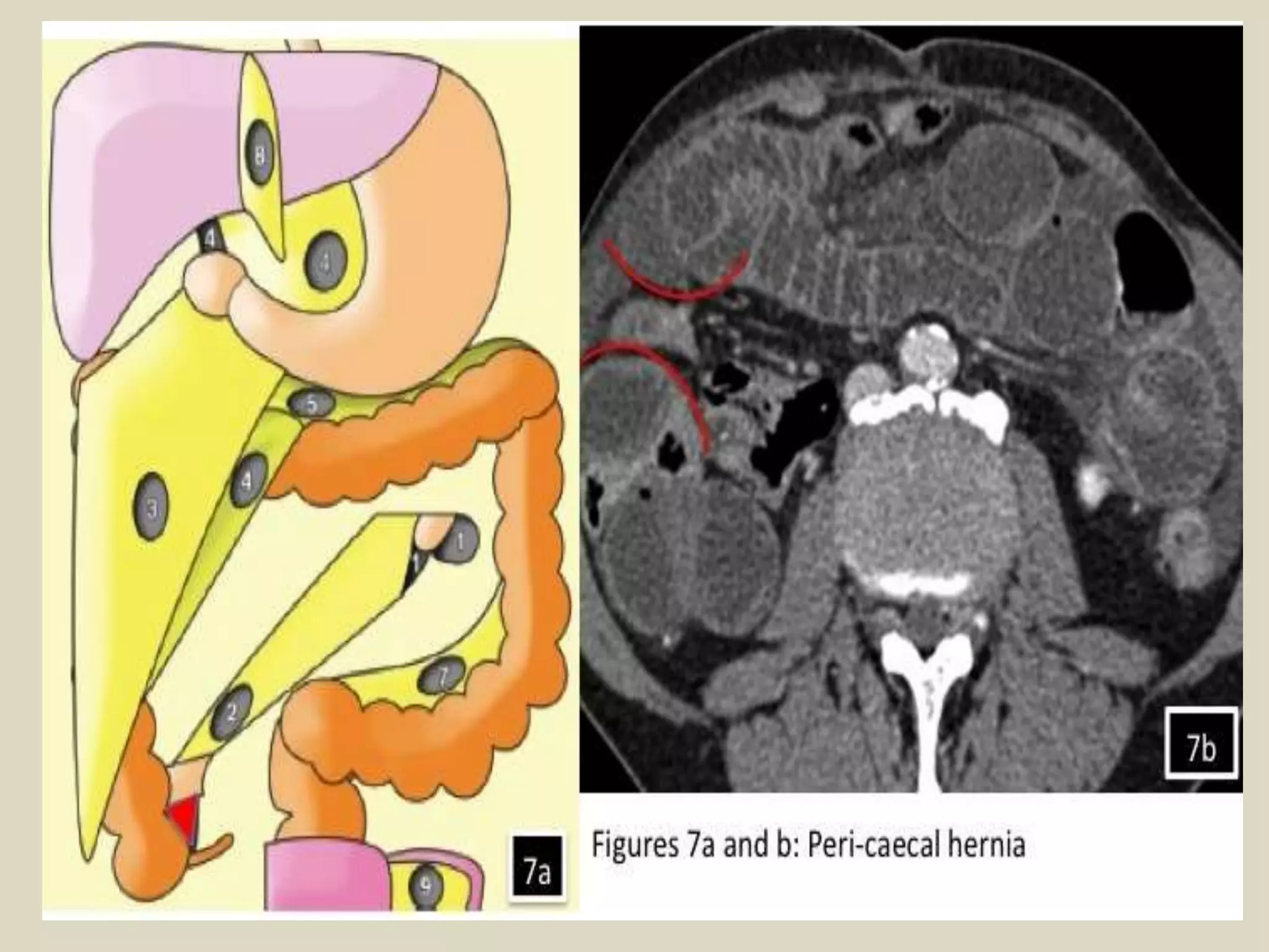 Presentation1, radiological imaging of internal abdominal hernia. | PPTX