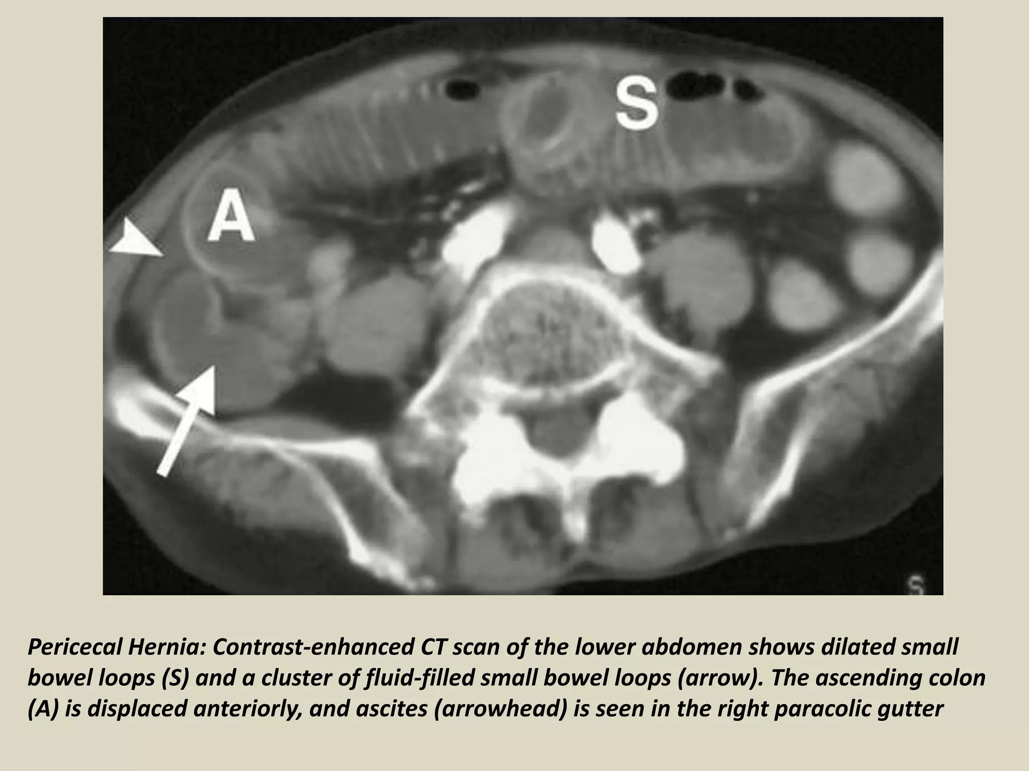 Presentation1, radiological imaging of internal abdominal hernia. | PPTX