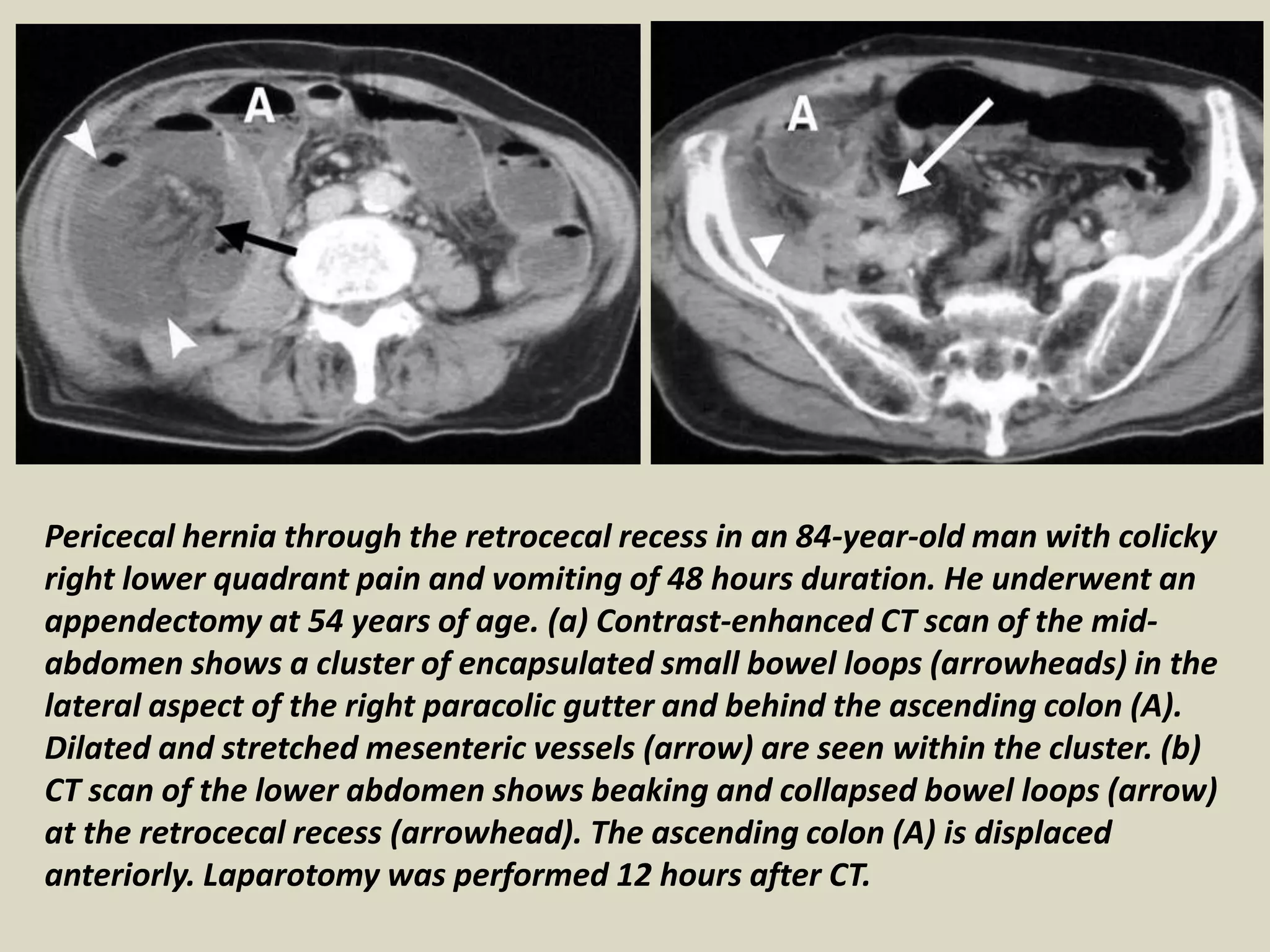Presentation1, radiological imaging of internal abdominal hernia. | PPTX