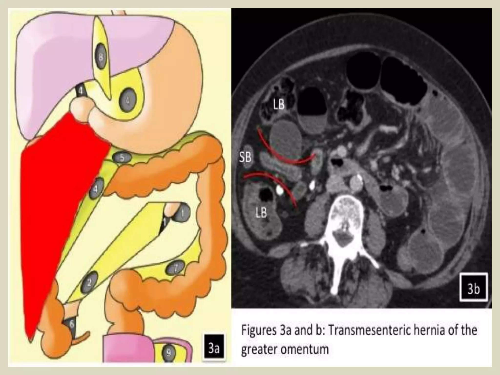 Presentation1, radiological imaging of internal abdominal hernia. | PPTX