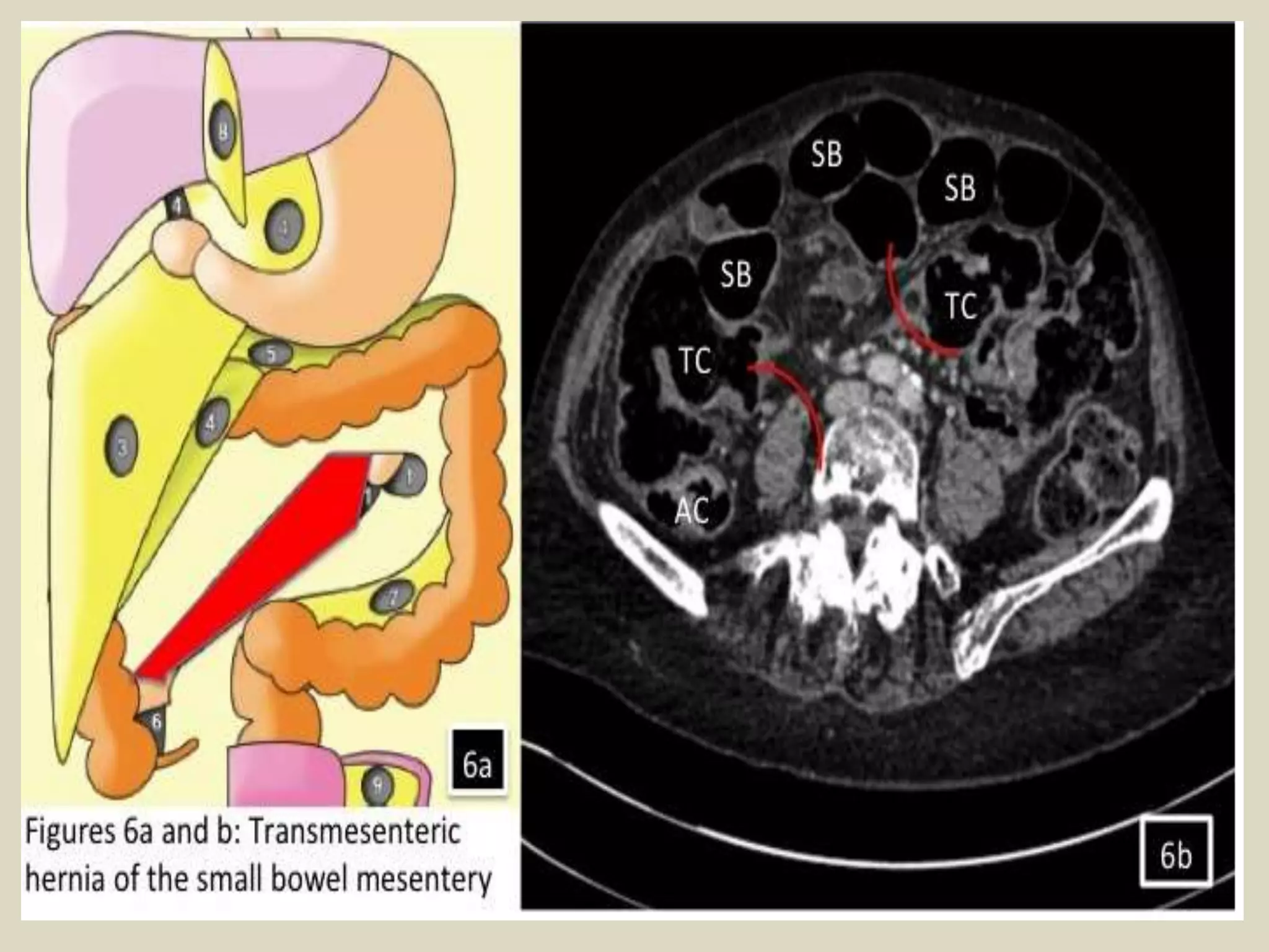 Presentation1, radiological imaging of internal abdominal hernia. | PPTX